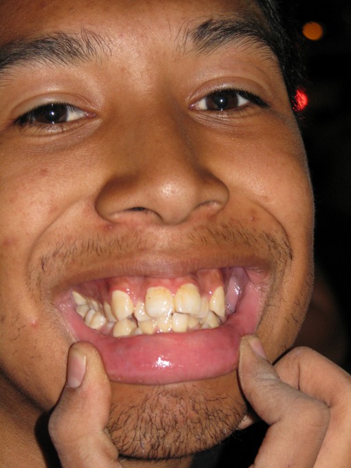 Weird Teeth – Aug 4, 2008 | normalbob.com